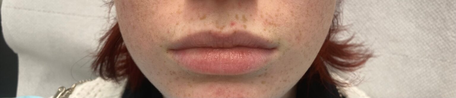 Signature Lip Filler Heathfield | Windsor Mews Aesthetics