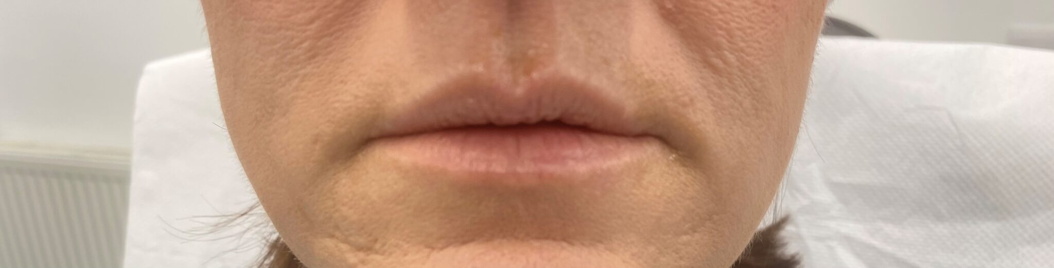 Signature Lip Filler Heathfield | Windsor Mews Aesthetics